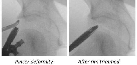 Hip Injuries - Midlands Orthopaedics & Neurosurgery